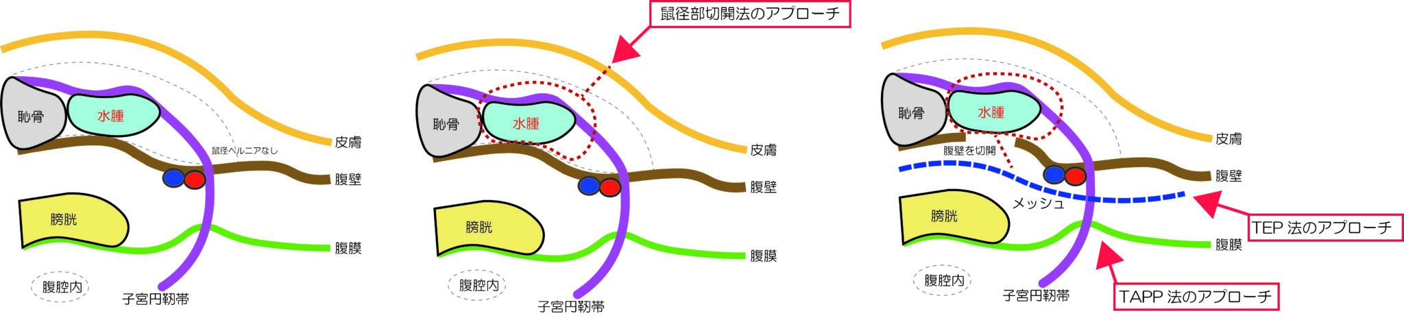 Nuck管水腫（ヌック管水腫）について - 西宮敬愛会病院 COKU 鼠径ヘルニア・内視鏡センター