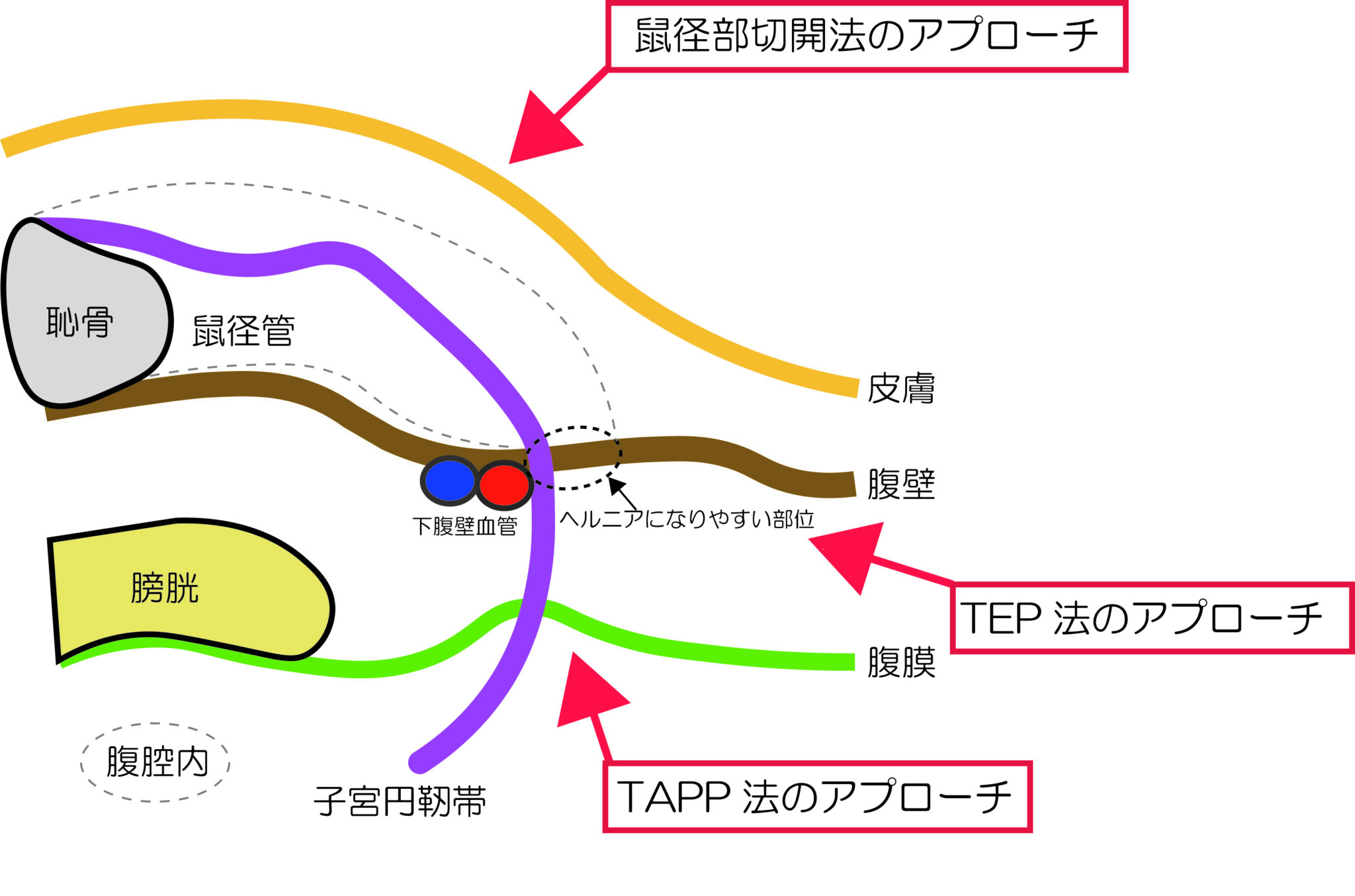 Nuck管水腫（ヌック管水腫）について - 西宮敬愛会病院 COKU 鼠径ヘルニア・内視鏡センター